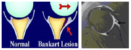 Dr. Rajesh Garg | Bankart Repair for Recurrent