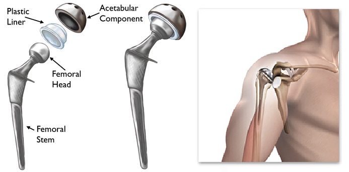 Best Shoulder Surgeon In Dubai - Drrajeshgarg